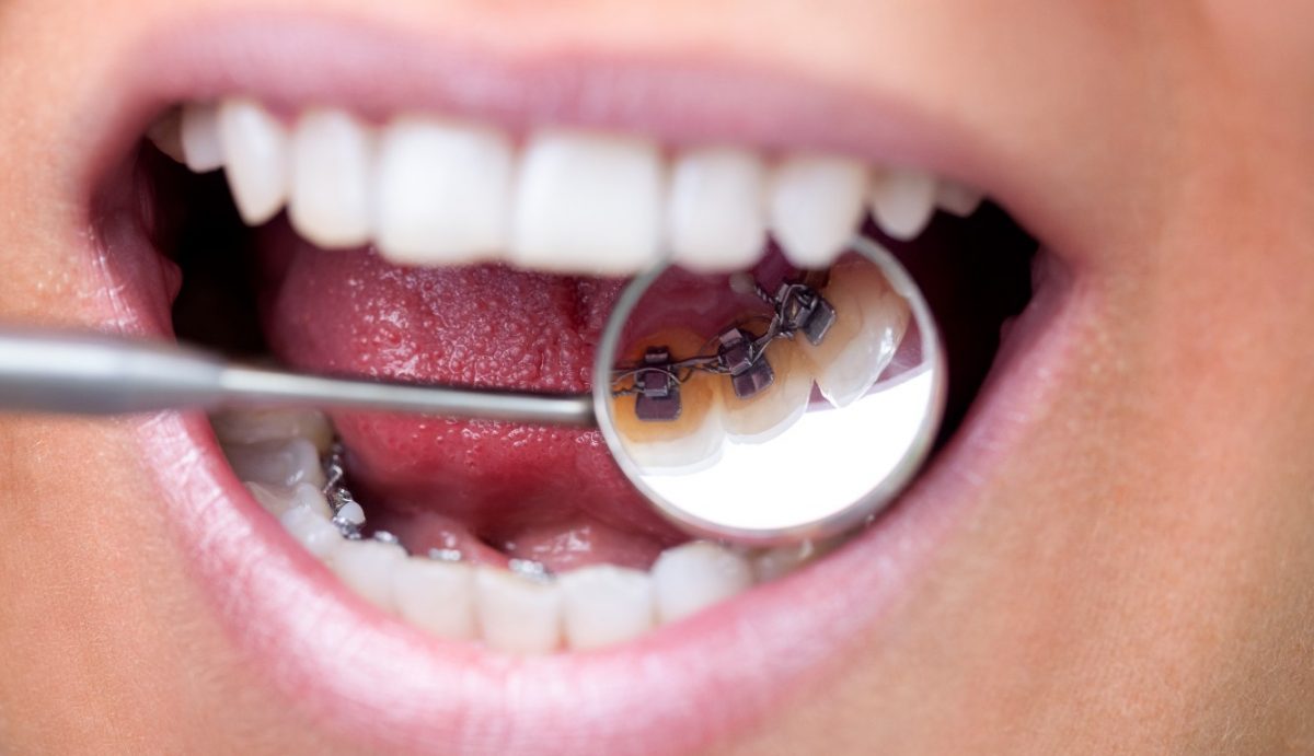 Aparelhos linguais: conheça a proposta e as suas vantagens