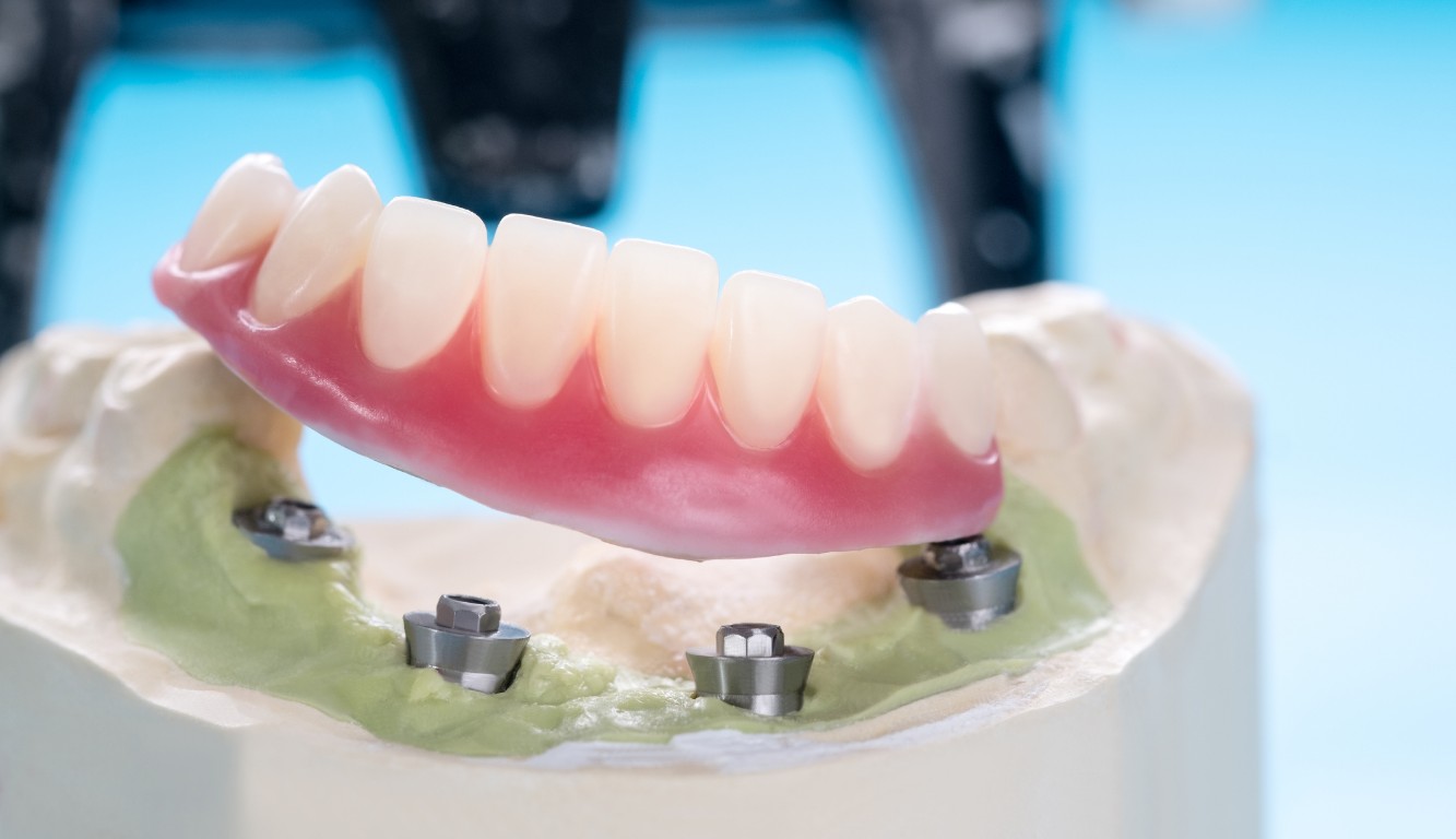 Implante overdenture: entenda todos os detalhes envolvidos