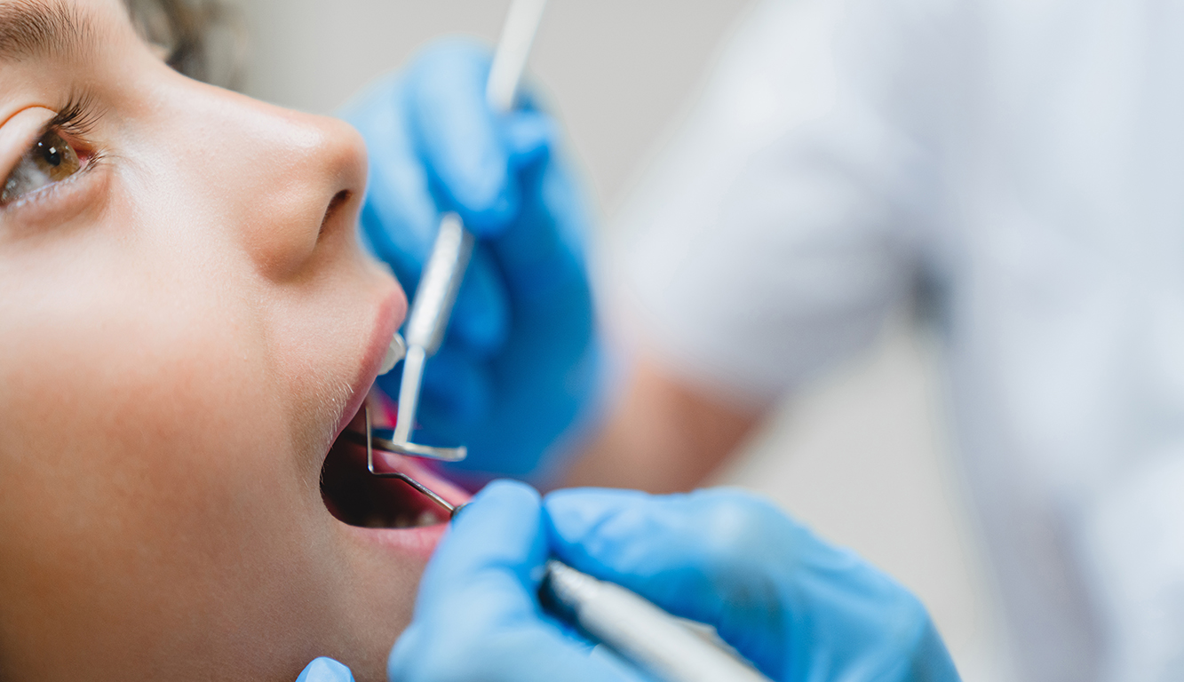 Cárie inicial: tipos de cáries e quando tratar