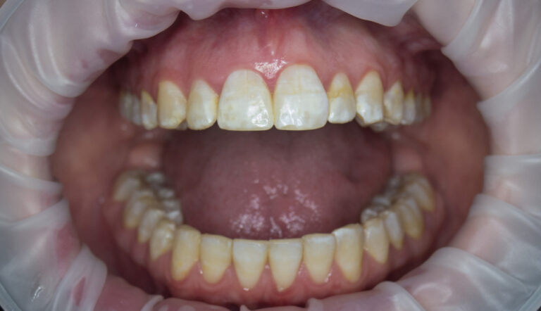 Fluorose dentária e manchas brancas nos dentes: saiba mais