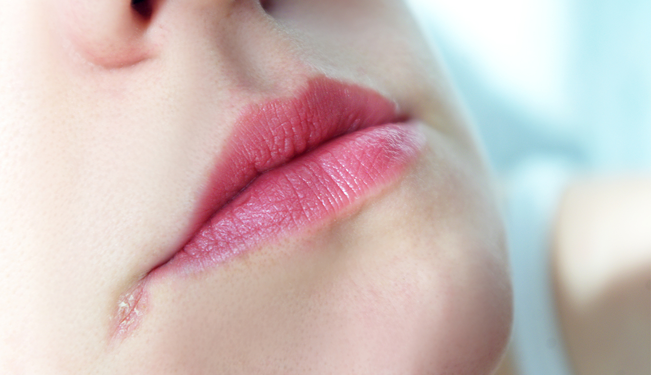 Queilite angular: o que é, sintomas, causas e tratamentos