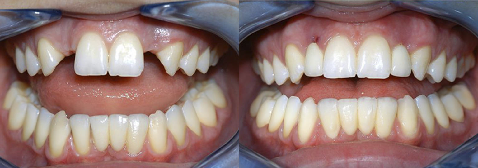 Agenesia dentária: o que é, causas e tratamentos